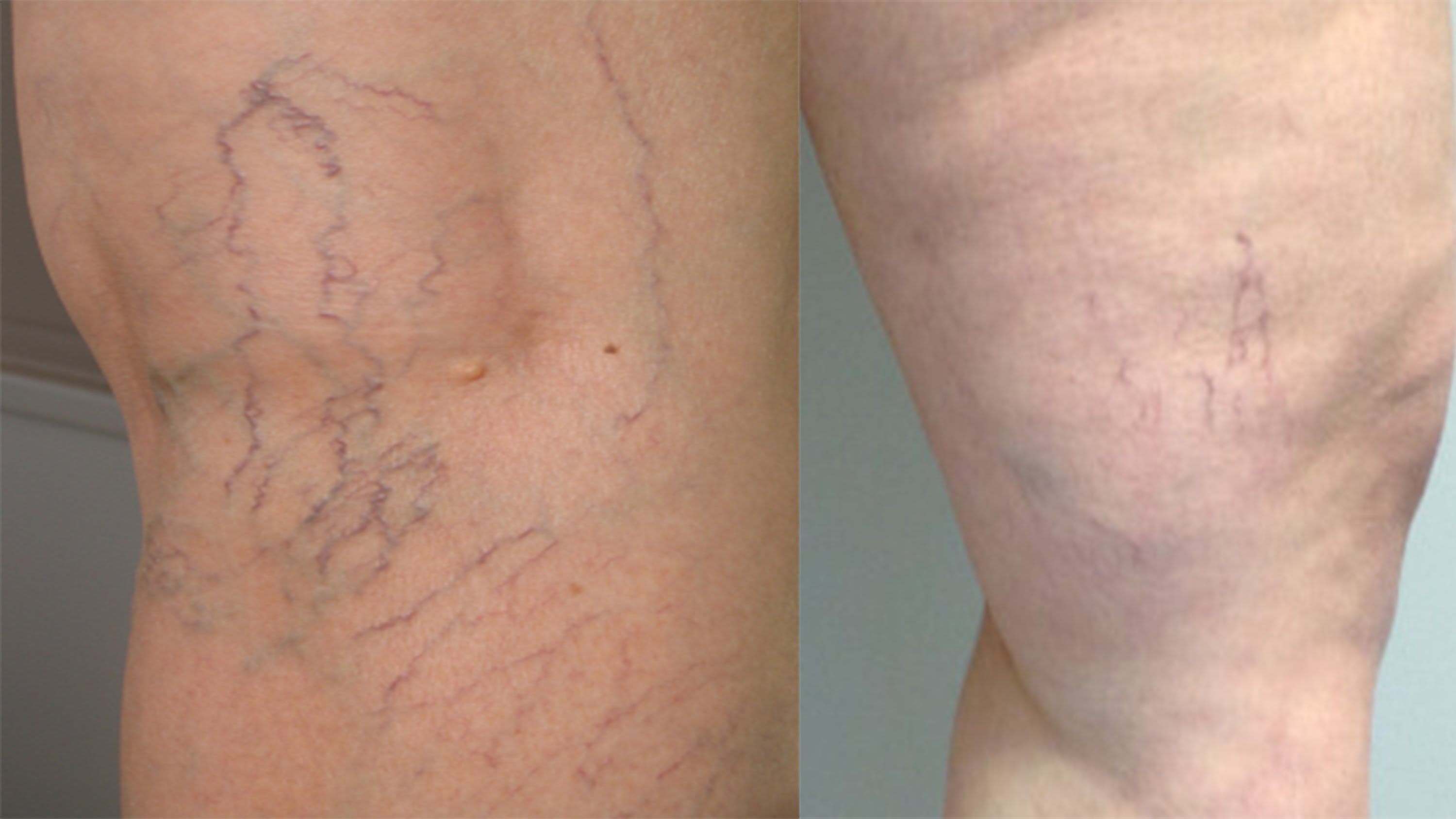 Varices jambes : la source du problème